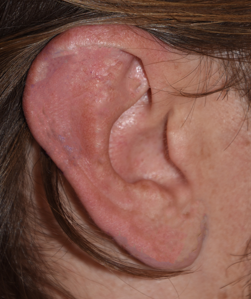 The Long Term Scar Results From Macrotia Reduction (Vertical Ear ...