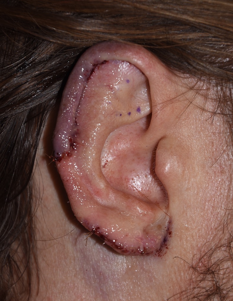 The Long Term Scar Results From Macrotia Reduction (Vertical Ear ...