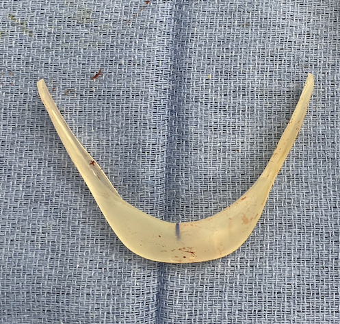 3D Assessment of Chin Implant Imprinting and Bone Overgrowth - Explore ...