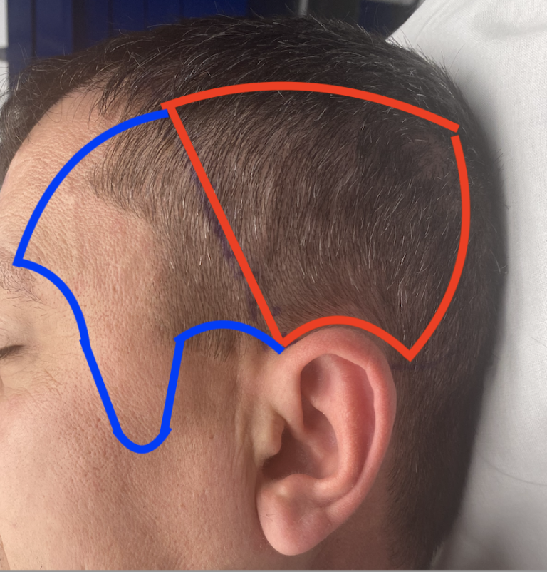 Plastic Surgery Case Study - Male Side of the Head Reductive Reshaping ...