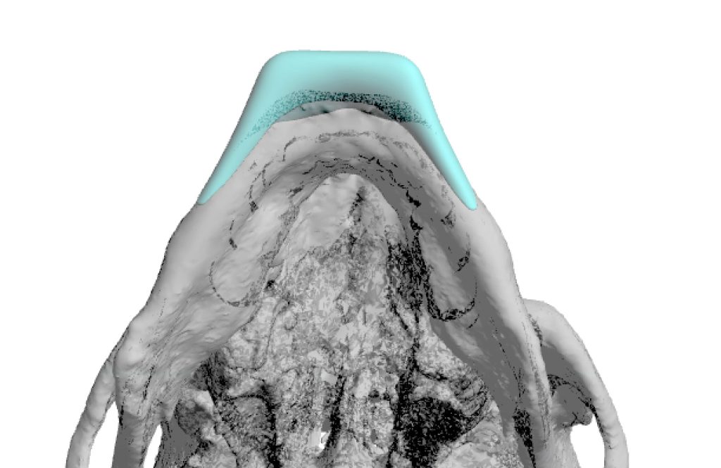 Concepts and Misconceptions of the Square Chin Implant - Explore ...