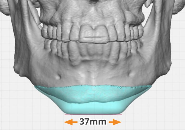 Concepts and Misconceptions of the Square Chin Implant - Explore ...