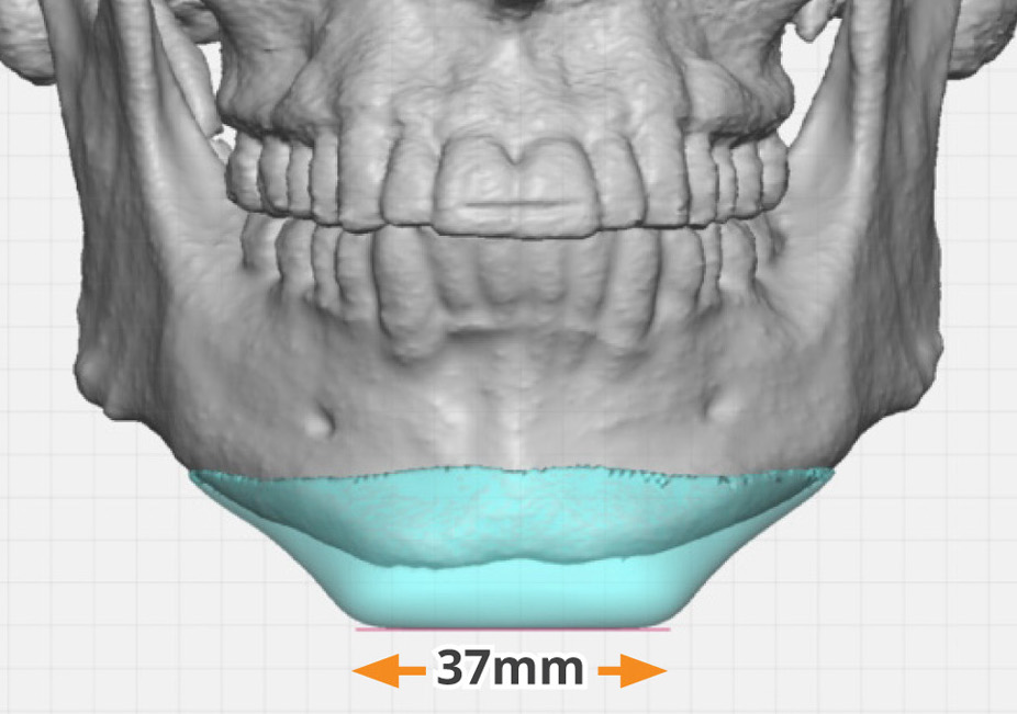 Concepts and Misconceptions of the Square Chin Implant - Explore ...