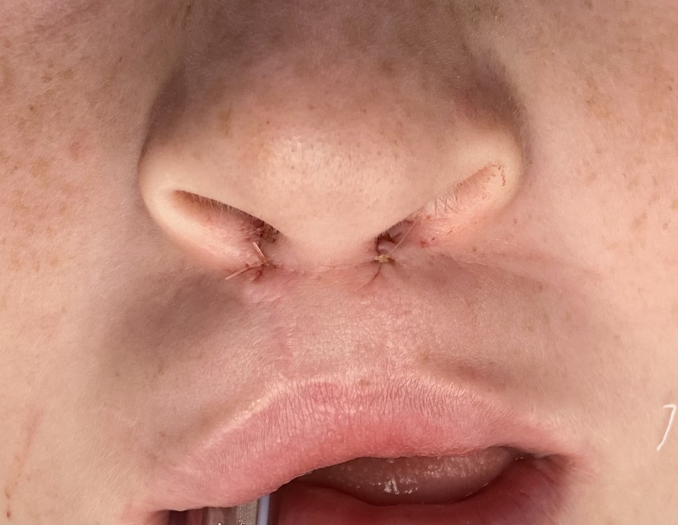 Plastic Surgery Case Study - Secondary Nostril Narrowing and Upper Lip ...