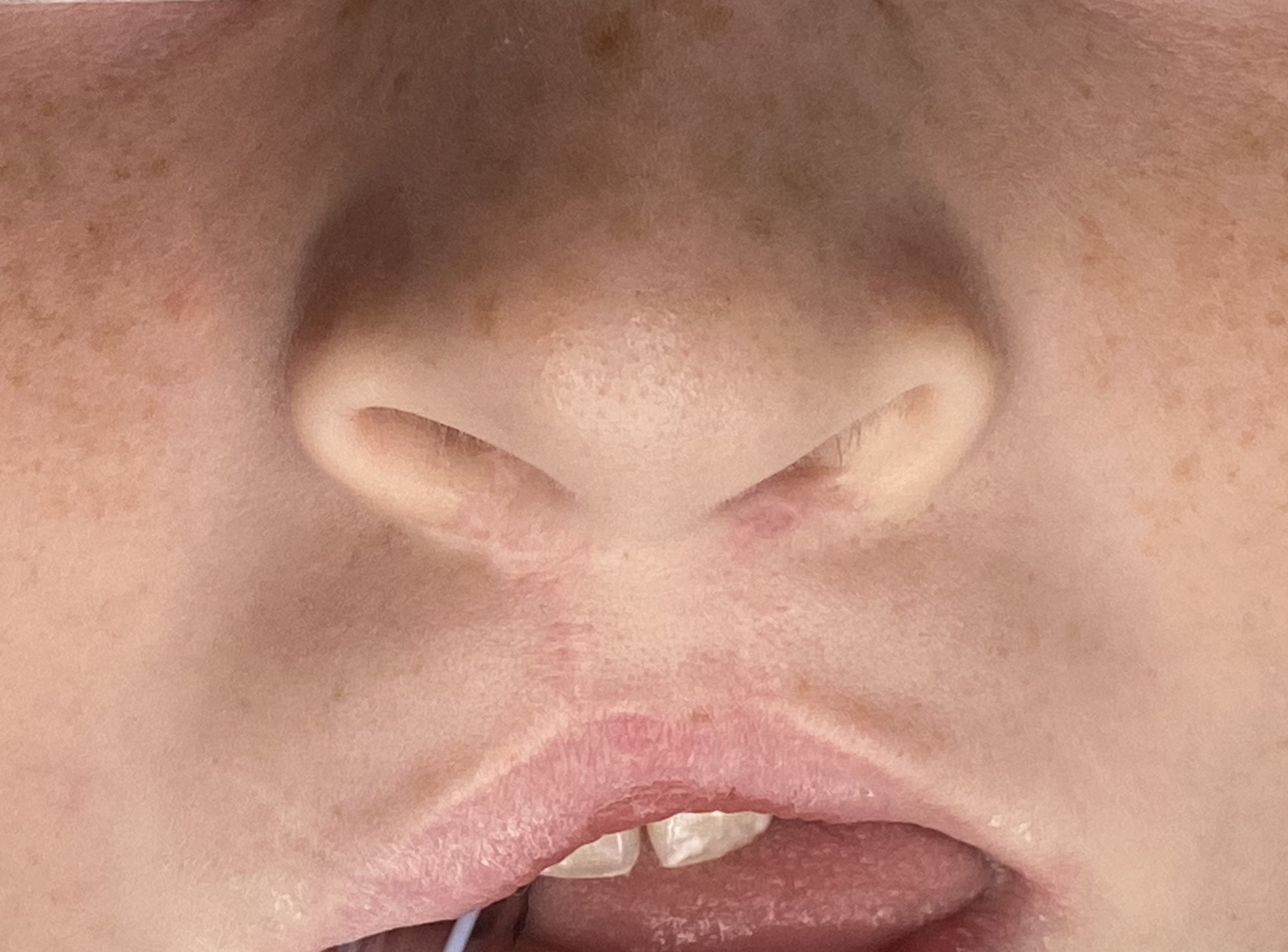 Plastic Surgery Case Study - Secondary Nostril Narrowing and Upper Lip ...