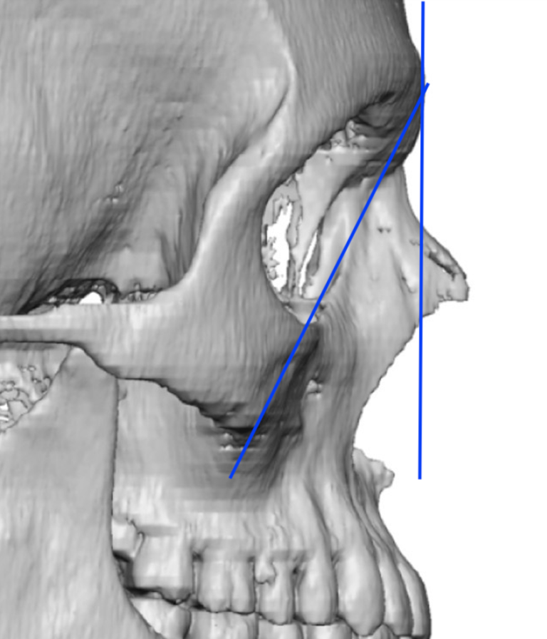 Types and Indications of Infraorbital Rim Implants - Explore Plastic ...