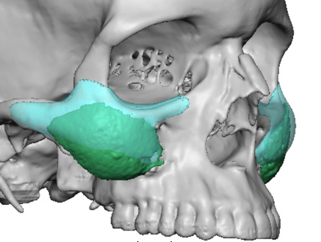 Plastic Surgery Case Study - Custom Infraorbital-Cheek Implants ...