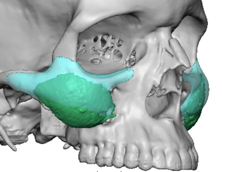 Plastic Surgery Case Study - Custom Infraorbital-Cheek Implants ...