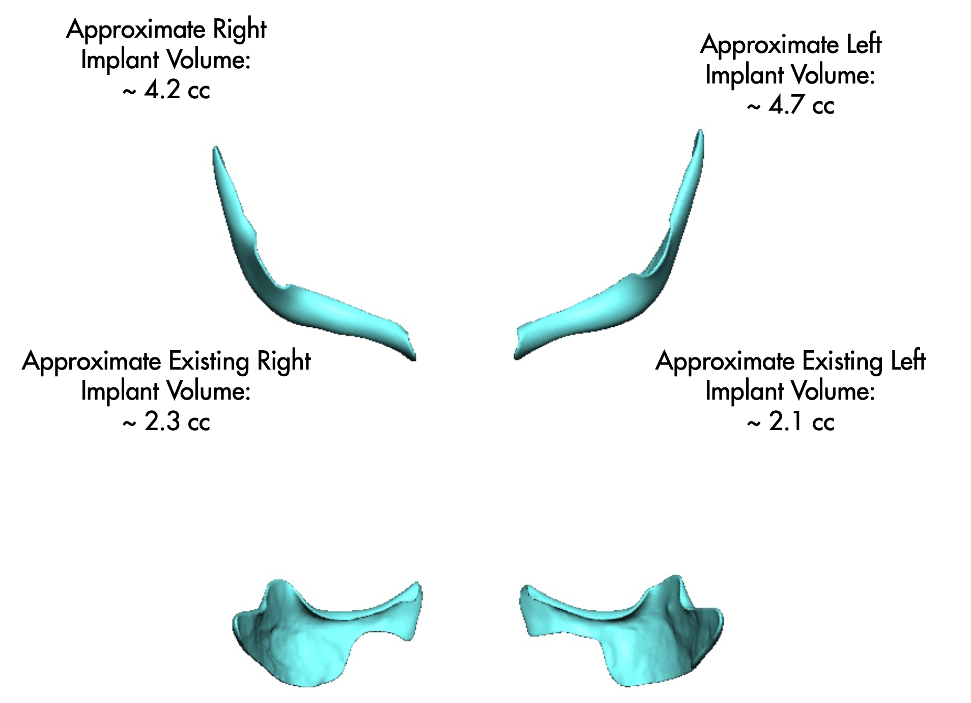 Plastic Surgery Case Study - Custom Infraorbital-Cheek Implants ...