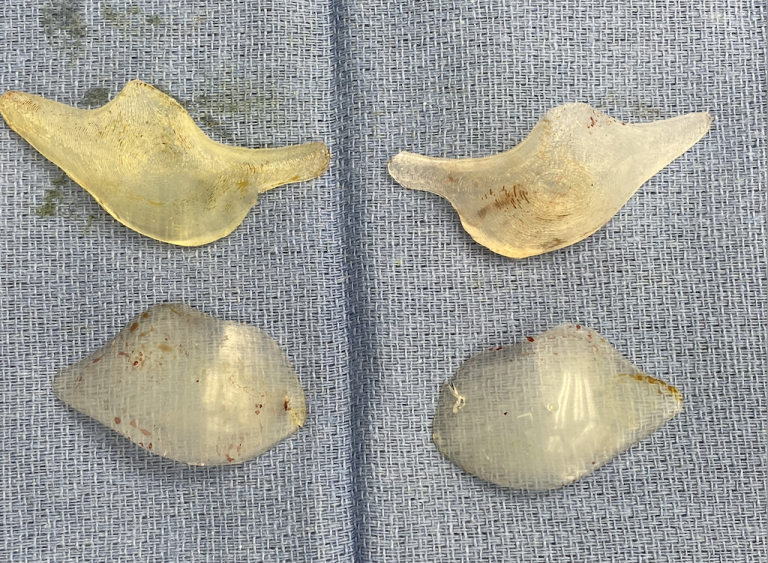 Plastic Surgery Case Study - Custom Infraorbital-Cheek Implants ...