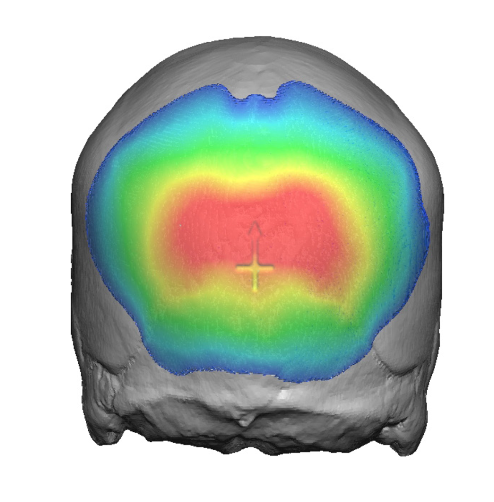 Plastic Surgery Case Study - The Angular Projecting Custom Skull ...