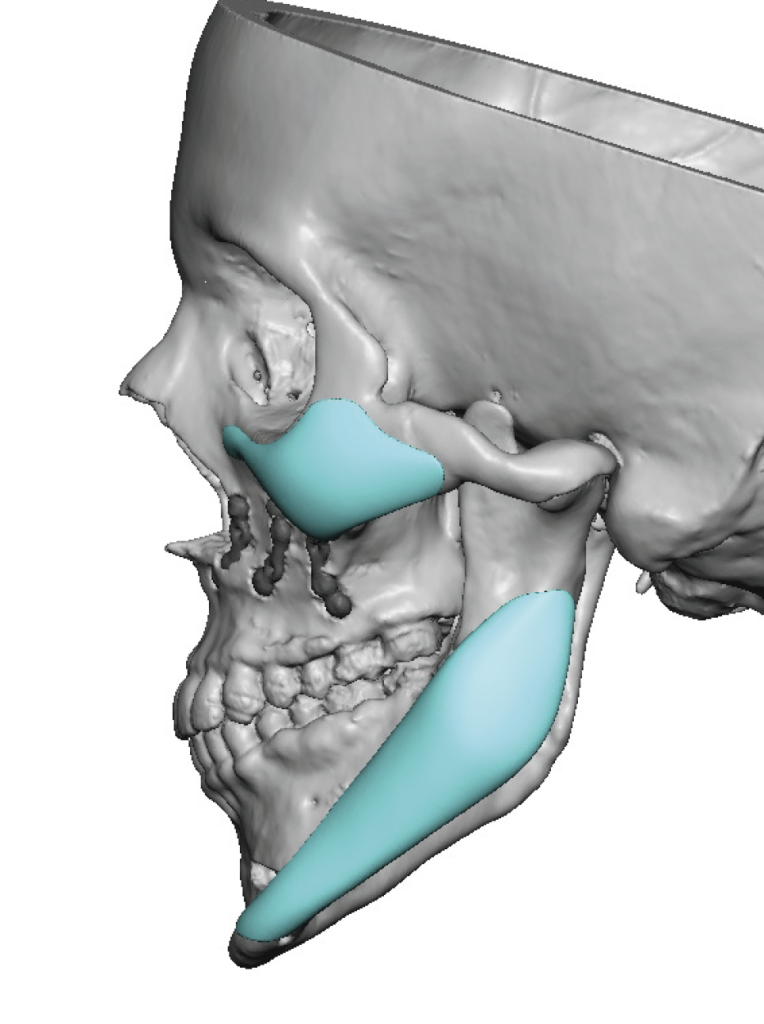custom cheek and jaw implant designs side view Dr Barry Eppley ...