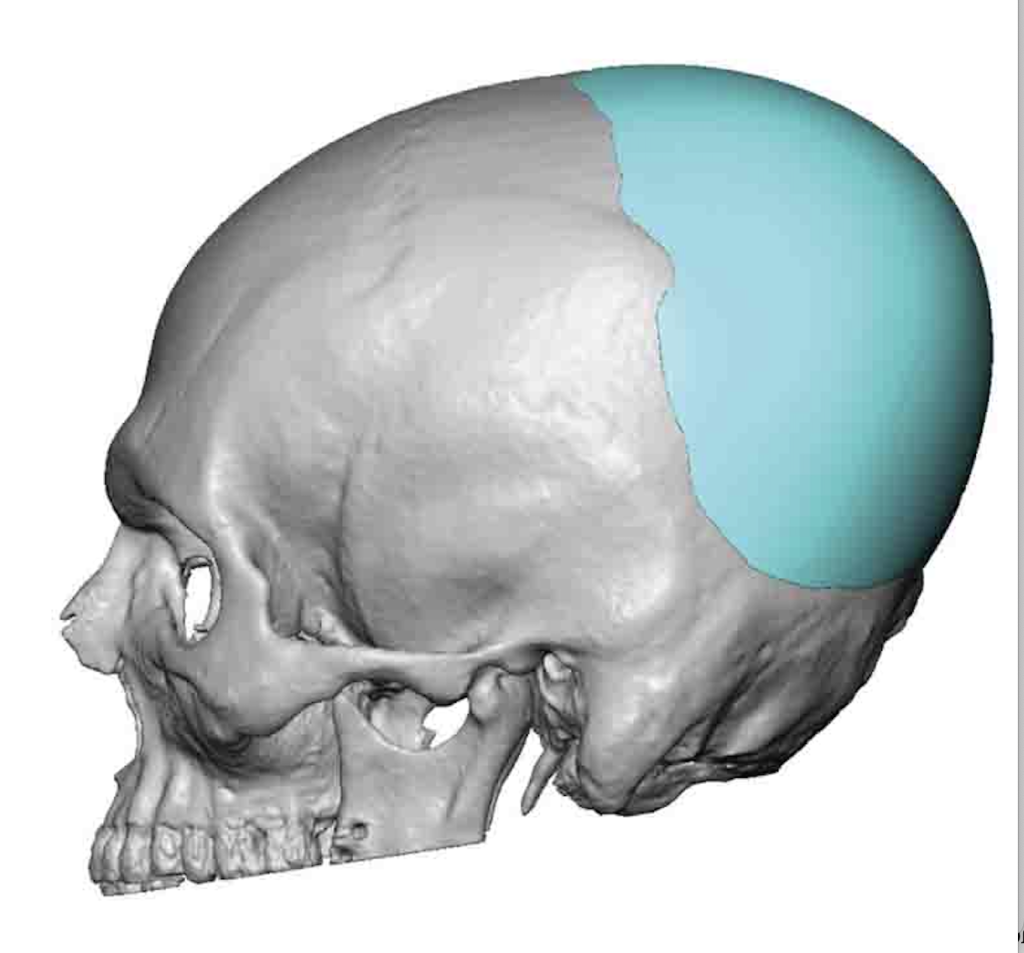 Plastic Surgery Case Study - The Custom High Back of the Head Skull ...