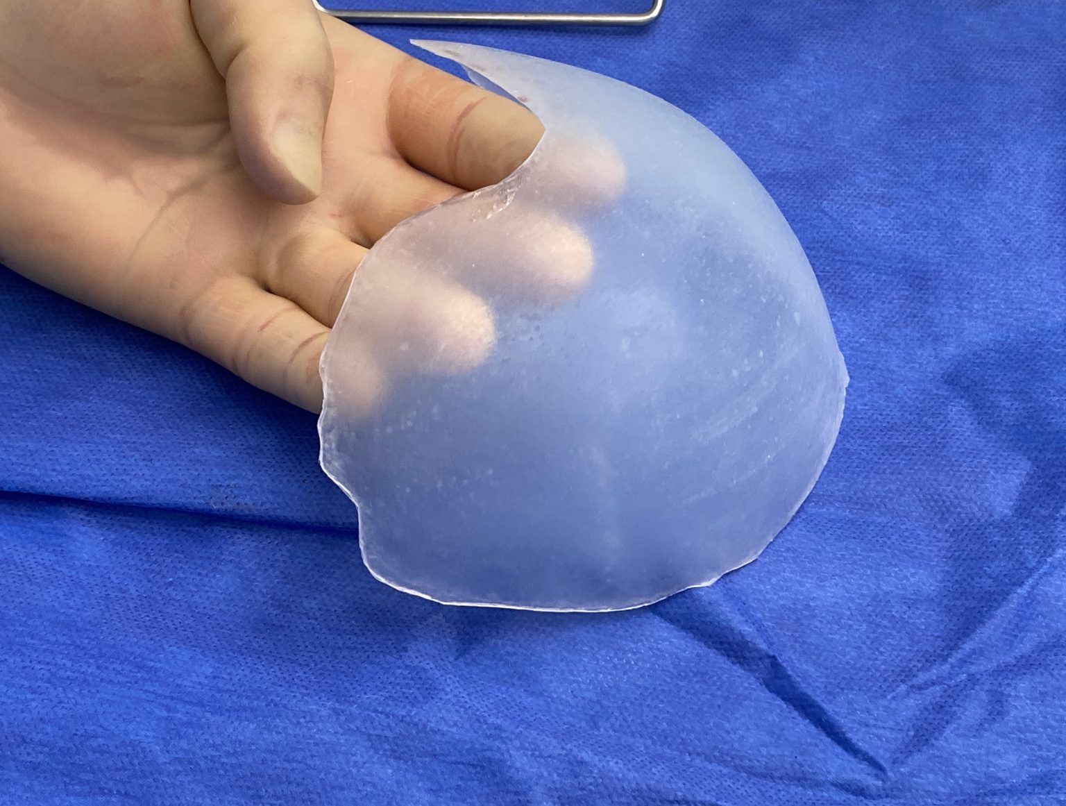 Plastic Surgery Case Study - Correction of an Upper Forehead Slope with ...