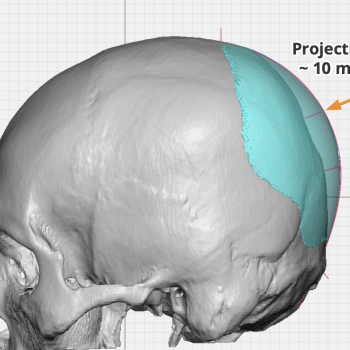 skull reshaping Archives - Explore Plastic Surgery