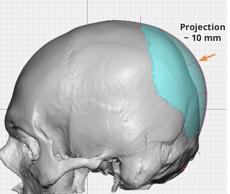 Plastic Surgery Case Study - The Angular Projecting Custom Skull ...