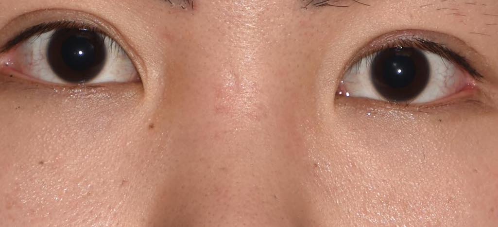 Plastic Surgery Case Study - Medial Epicanthoplasty Skin Flap ...