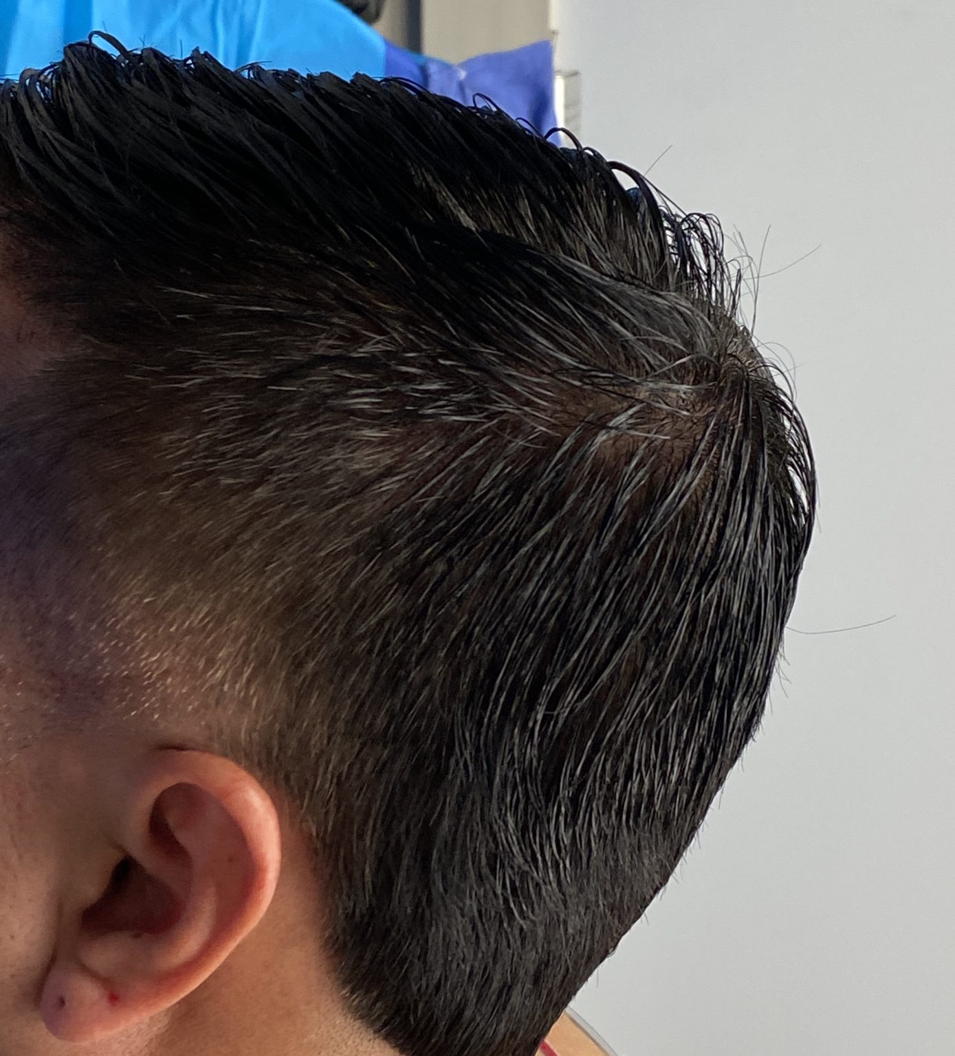 Plastic Surgery Case Study - The Custom High Back of the Head Skull ...