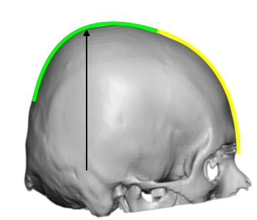 Plastic Surgery Case Study - The Custom High Back of the Head Skull ...
