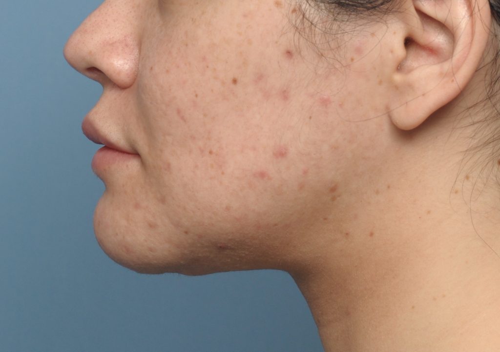 Facelift Surgery for Jowling Correction after V Line Jaw Reduction ...