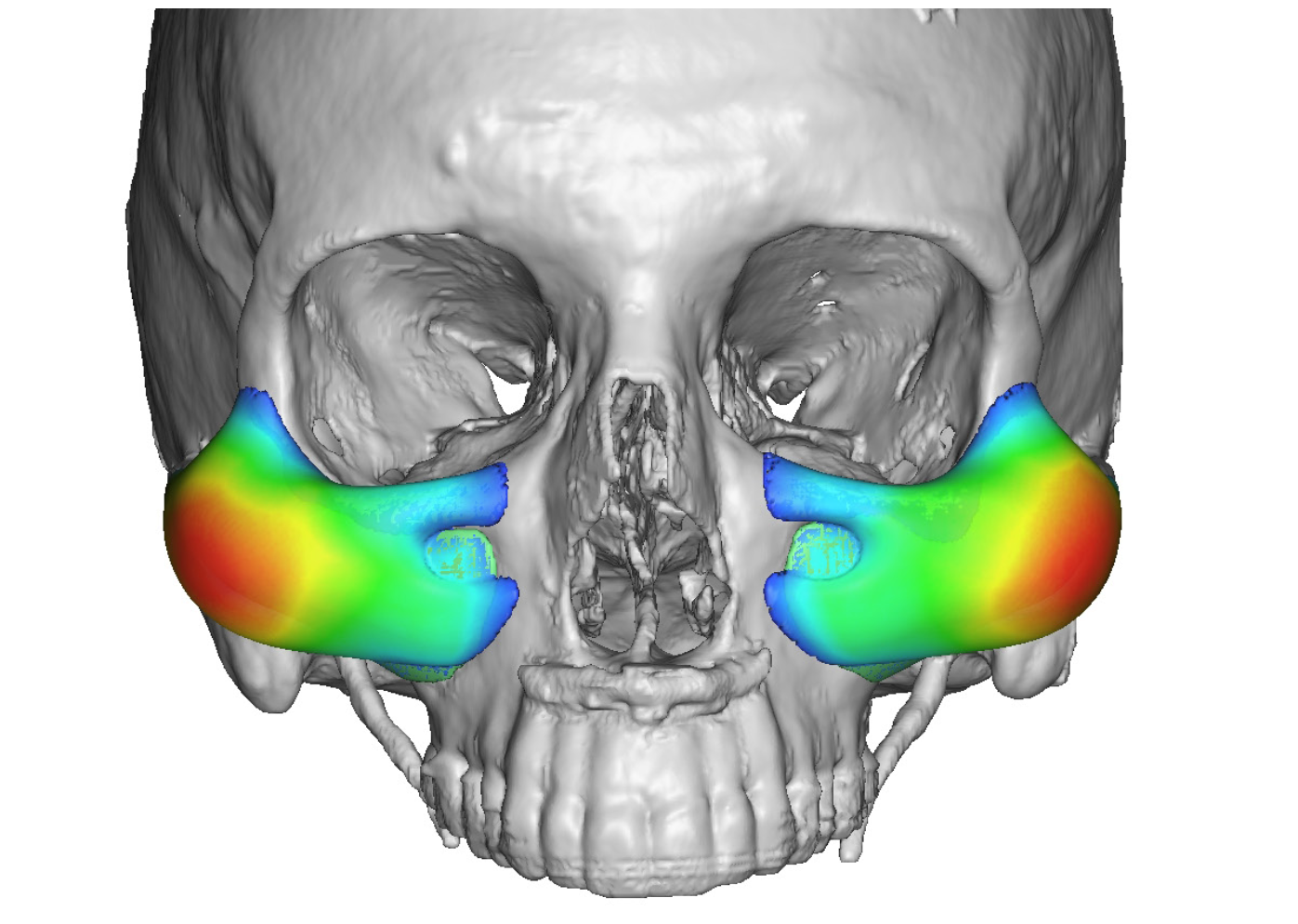 Plastic Surgery Case Study - Removal Of Medpor Cheek Implants With ...