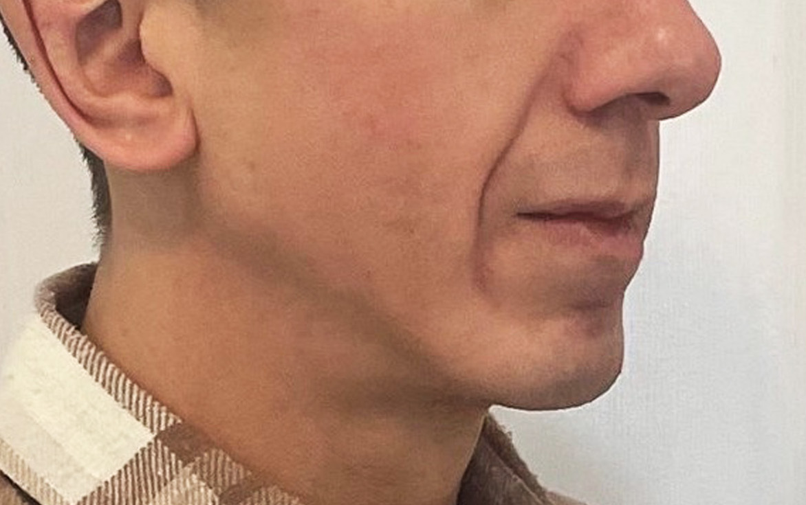 Plastic Surgery Case Study - Custom Jawline Implant Replacement for ...