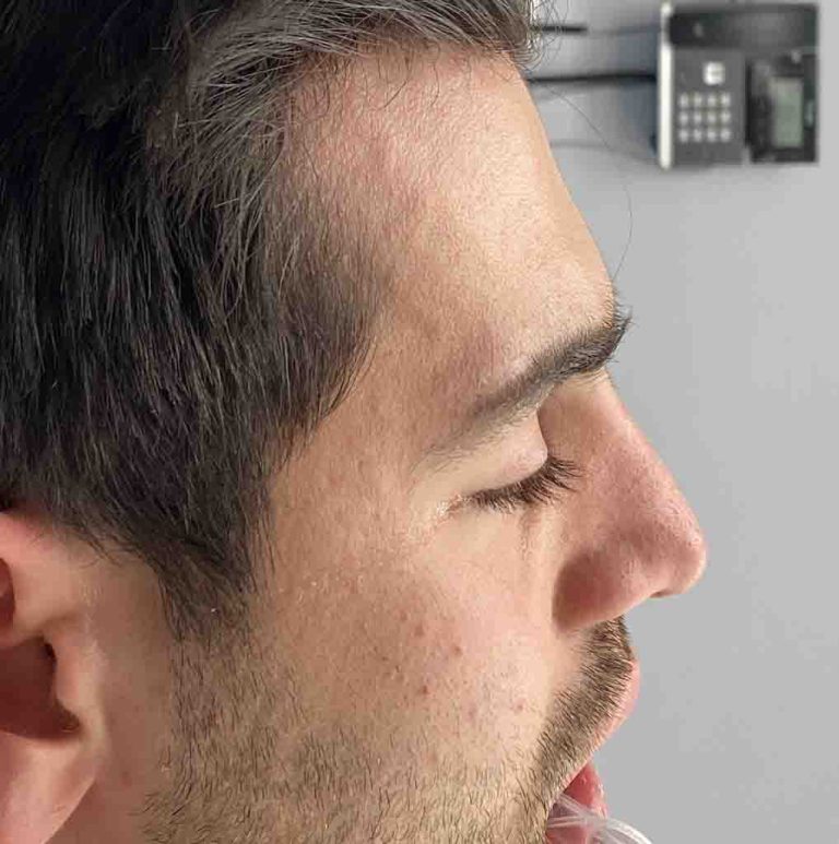 Plastic Surgery Case Study - Extended Custom Midface Implant for a ...