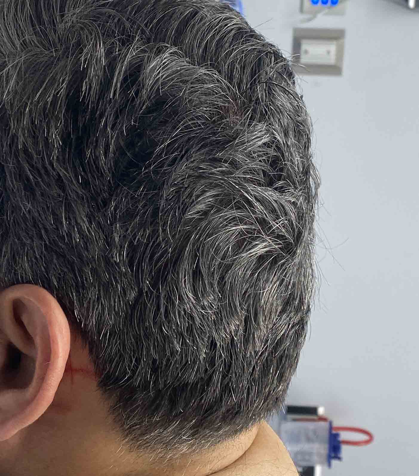 Plastic Surgery Case Study - The Angular Projecting Custom Skull ...