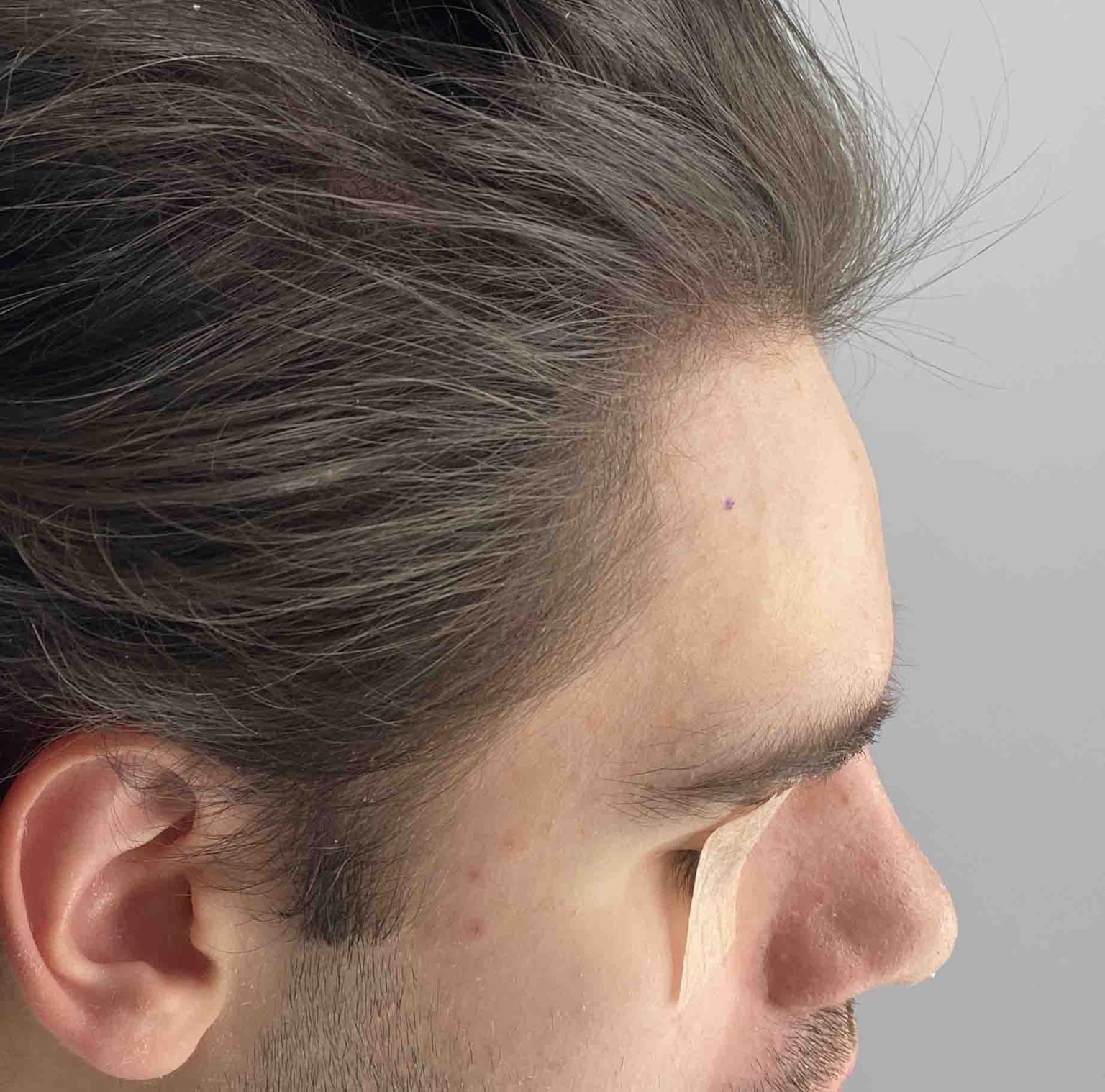 Plastic Surgery Case Study - Correction of an Upper Forehead Slope with ...