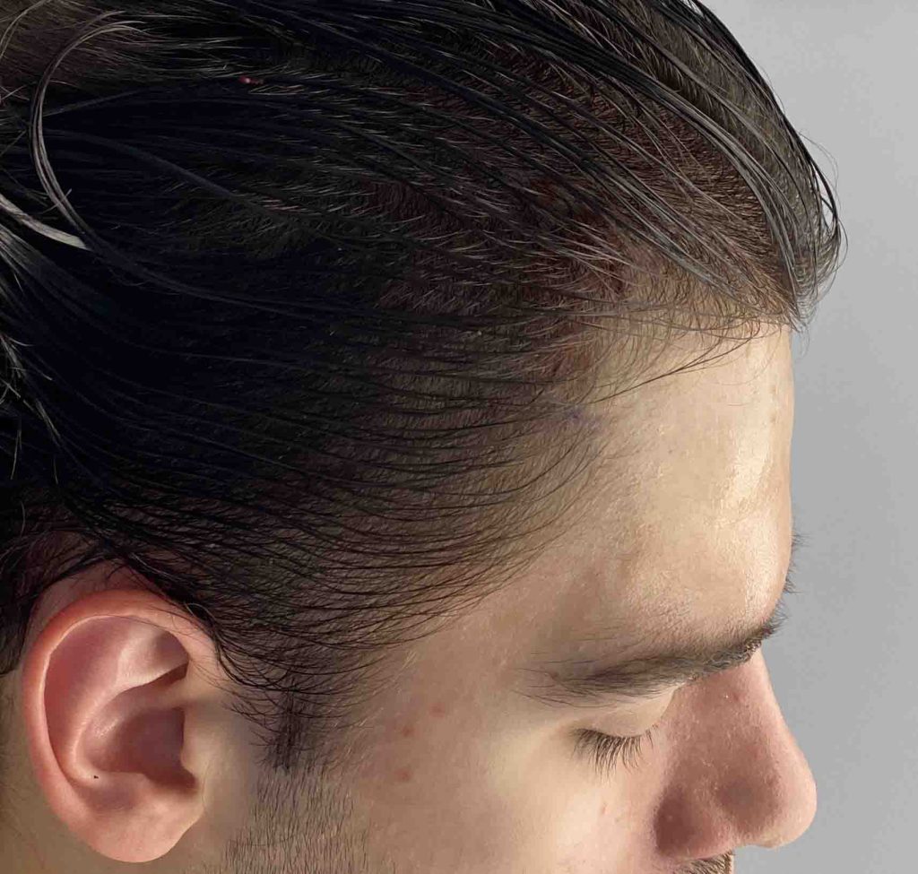 Plastic Surgery Case Study - Correction of an Upper Forehead Slope with ...