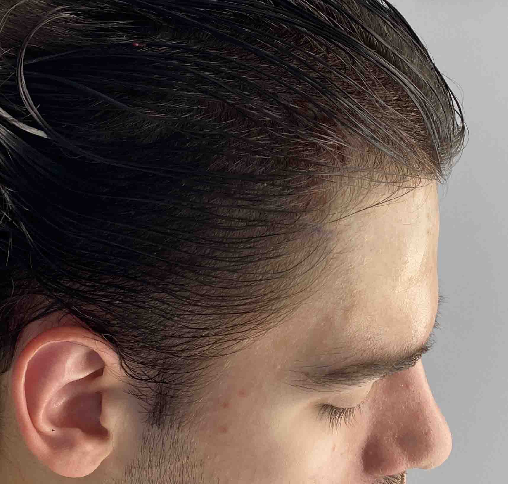 Plastic Surgery Case Study - Correction of an Upper Forehead Slope with ...