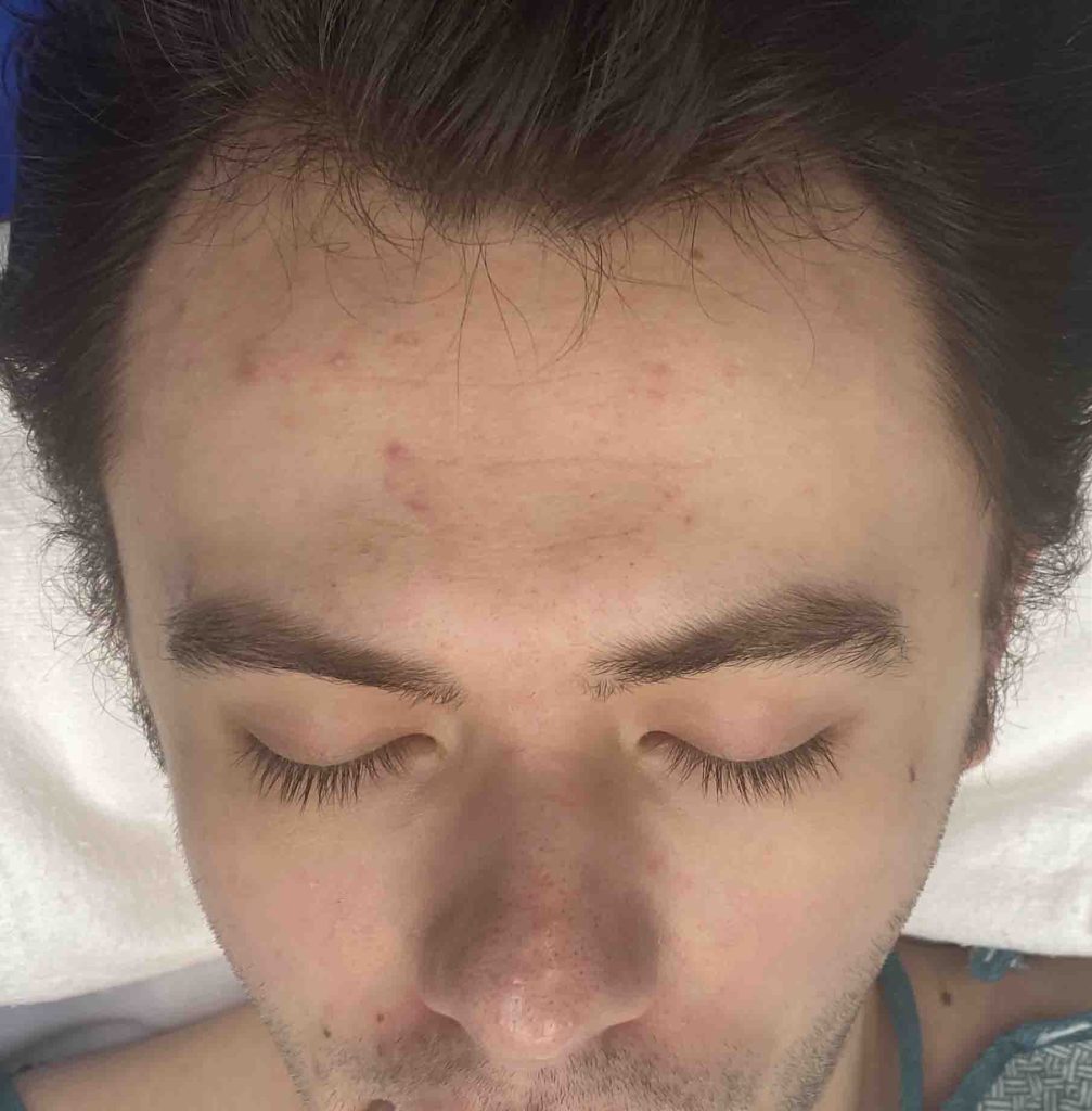 Plastic Surgery Case Study - Near Total Temporal Reduction For ...