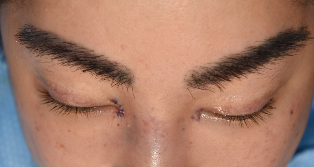 Plastic Surgery Case Study - Medial Epicanthoplasty Skin Flap Transposition Technique for ...