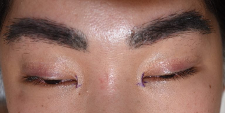 Plastic Surgery Case Study - Medial Epicanthoplasty Skin Flap Transposition Technique for ...