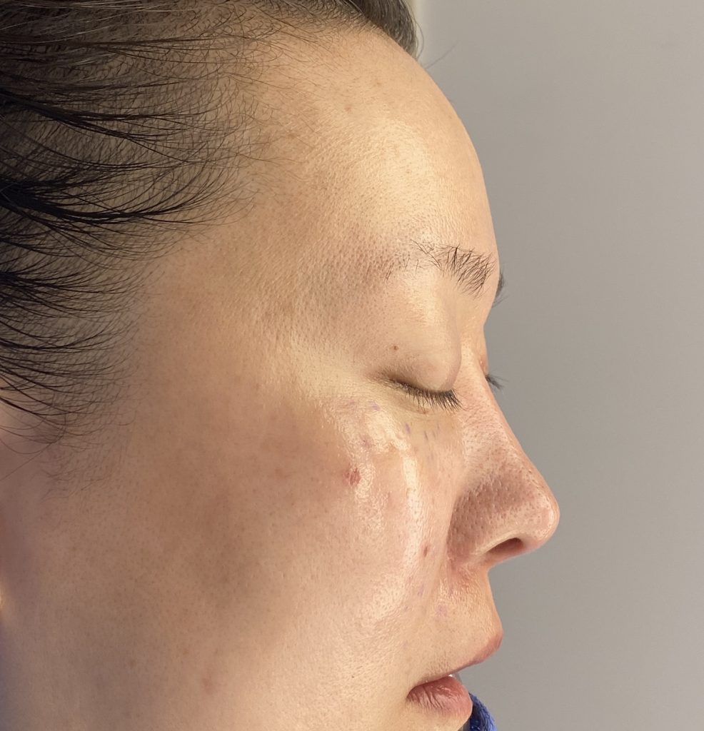 Plastic Surgery Case Study - Autologous Midface Augmentation Using ...