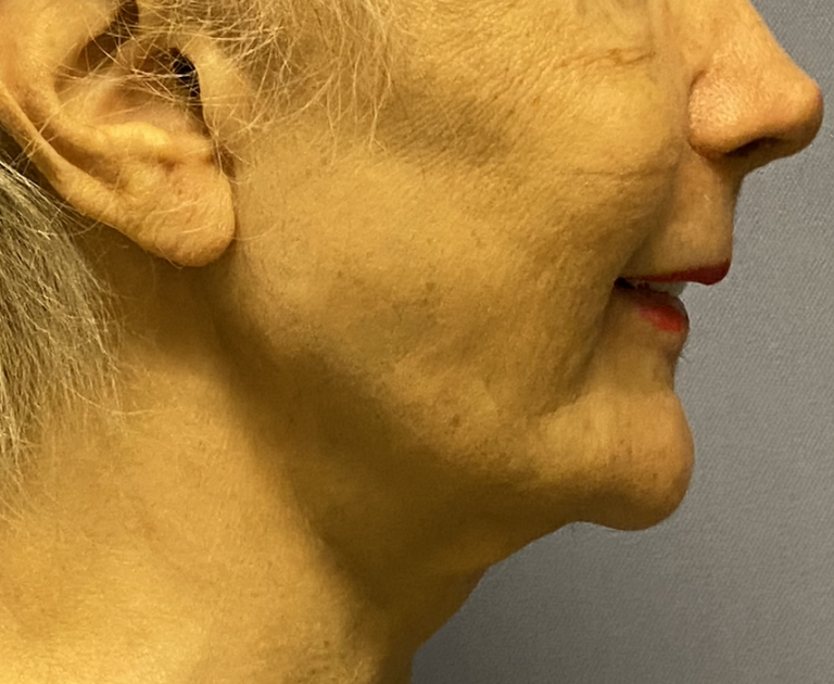 Plastic Surgery Case Study - Medpor Jaw Angle Implant Removals Using A ...