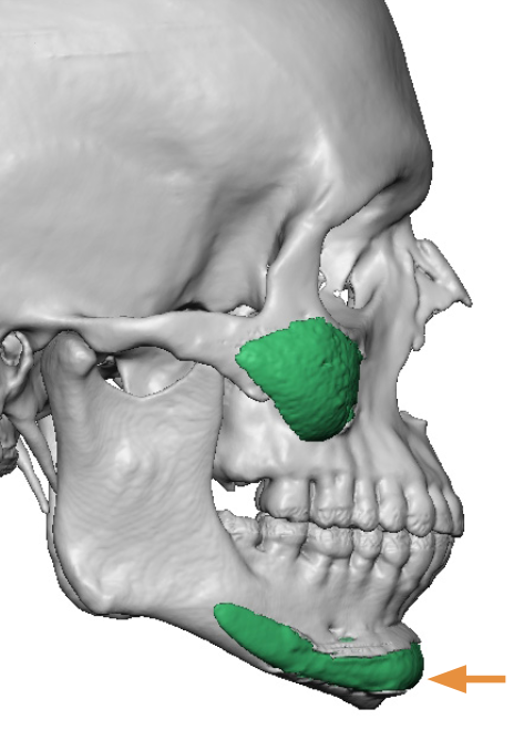 Concepts and Misconceptions of the Square Chin Implant - Explore ...