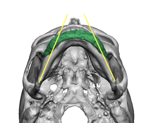 Concepts and Misconceptions of the Square Chin Implant - Explore ...