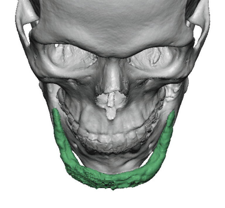 Concepts and Misconceptions of the Square Chin Implant - Explore ...