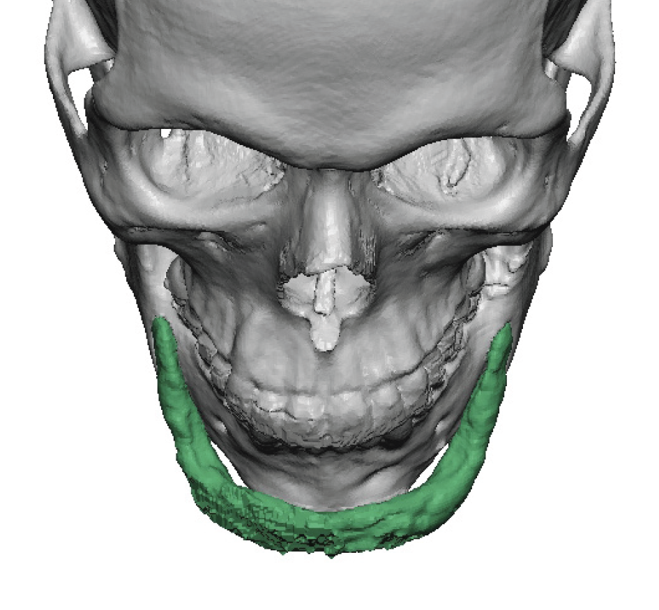 Concepts and Misconceptions of the Square Chin Implant - Explore ...
