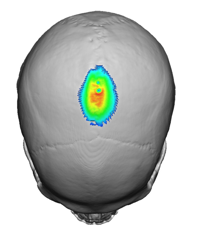 Plastic Surgery Case Study - Correction of an Upper Forehead Slope with ...