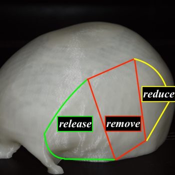temporal reduction Archives - Explore Plastic Surgery