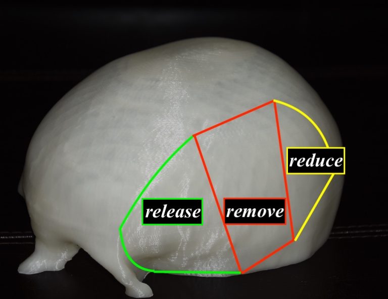 Plastic Surgery Case Study - Near Total Temporal Reduction For ...