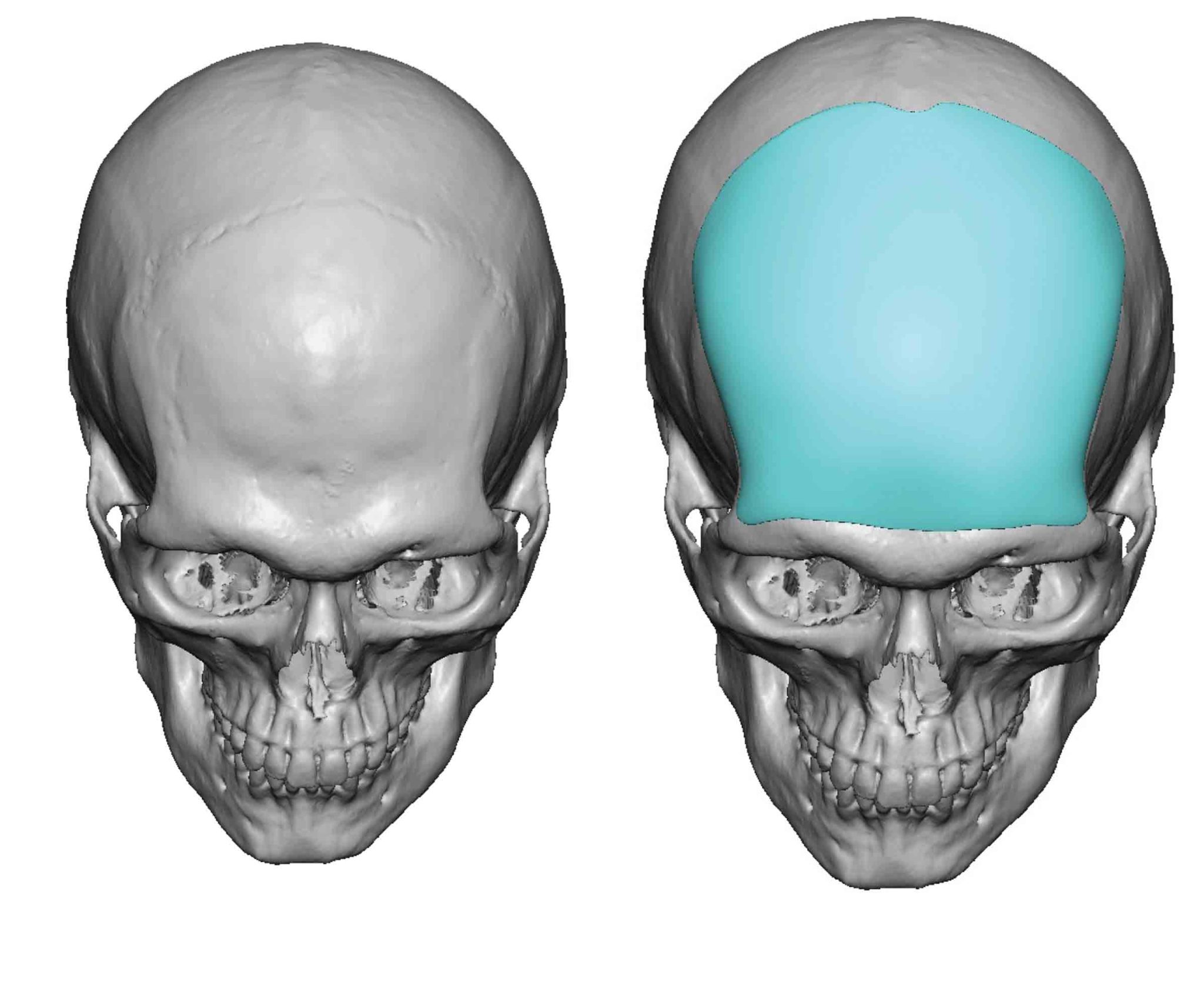 Plastic Surgery Case Study - Custom Forehead Augmentation In Male ...