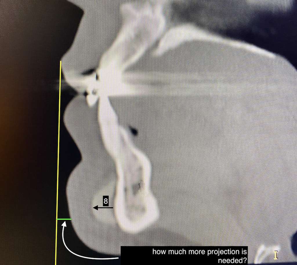 addkitional chin projection assessment Dr Barry Eppley - Explore ...