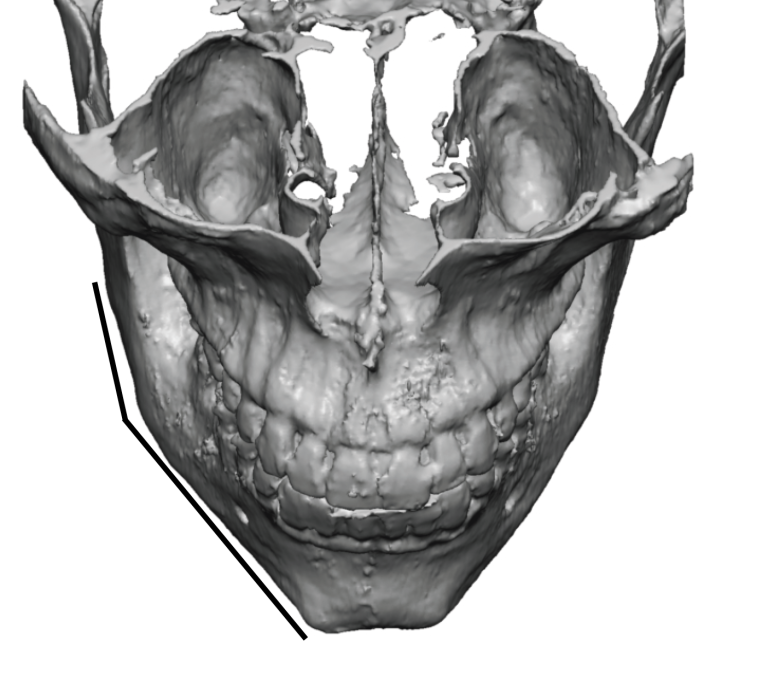 The Bony Anatomy of the Jaw Angles and Its Implications for Good ...