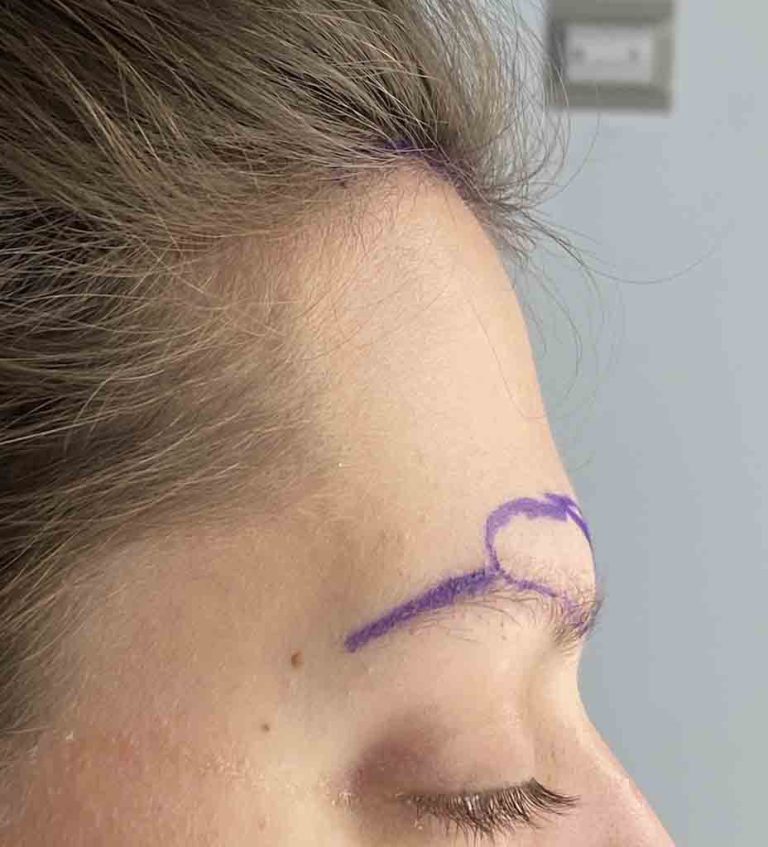 Plastic Surgery Case Study - Moderate Brow Bone Burring Reduction ...