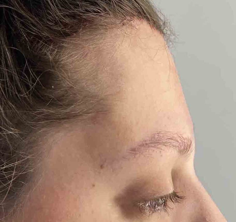 Plastic Surgery Case Study - Moderate Brow Bone Burring Reduction ...