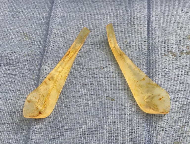 Plastic Surgery Case Study - Vertical Jawline Lengthening with Opening ...