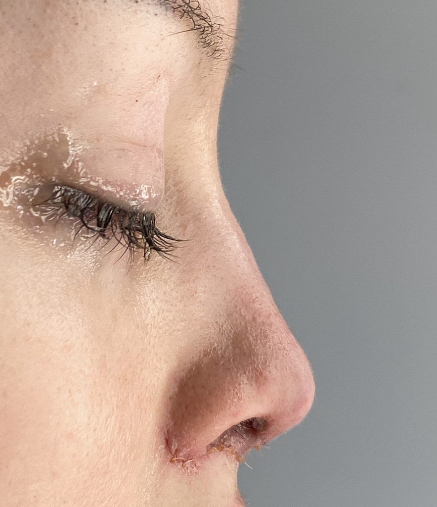 Plastic Surgery Case Study - Making A Smaller But Structurally Stable ...